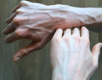 Understanding Bulging Veins: Causes, Health Implications, and What You ...